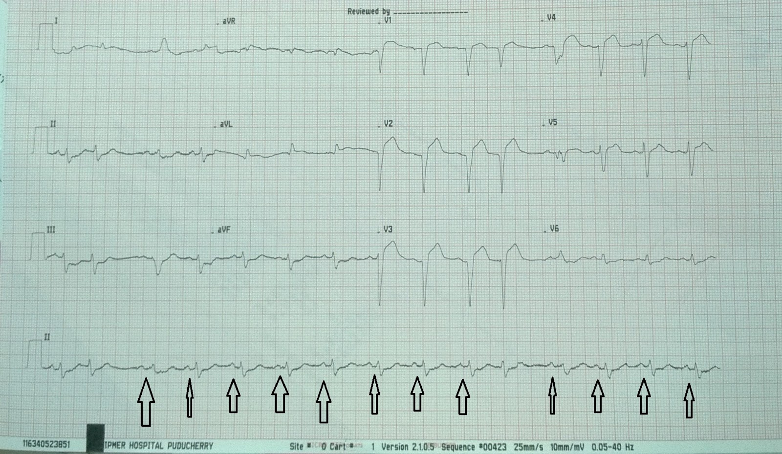 Cardiology window: AWMI with CHB