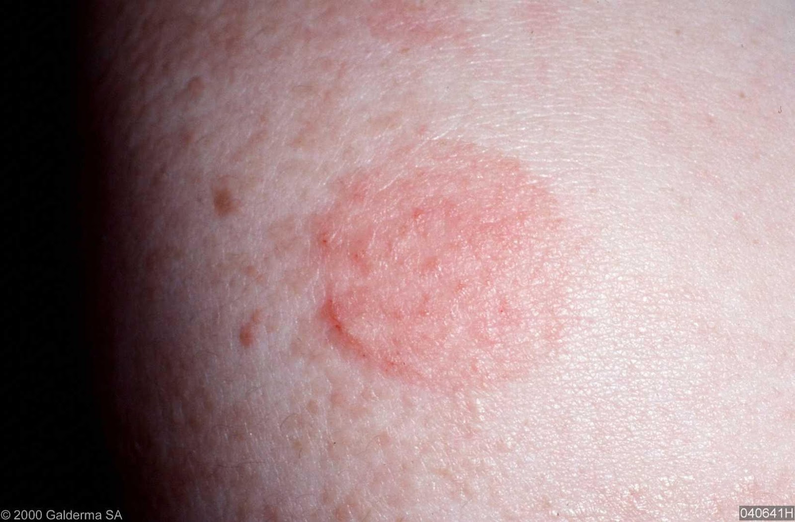 SKIN DISEASE TYPES: Nummular Dermatitis