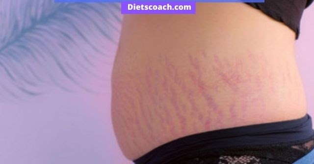Red Stretch Marks Treatments Causes red-stretch-marks-treatments-causes