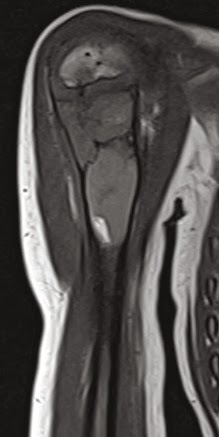 RADIODIAGNOSIS - IMAGE COLLECTION: SIMPLE BONE CYST