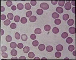 Células importantes en hematología: ESFEROCITOS