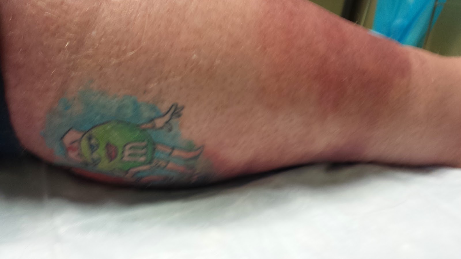 BubbaMike's Ramblings: Cellulitis (warning, graphic photos in this post)