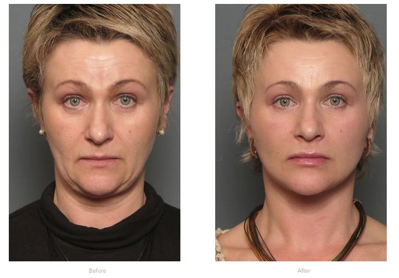 Rhytidectomy (Face Lift Cosmetic Surgery)