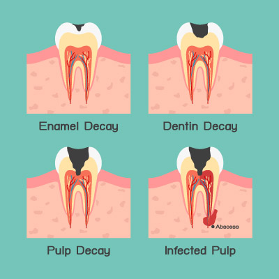 Pediatric Dentist, Bangalore: Process of Dental Caries in Children