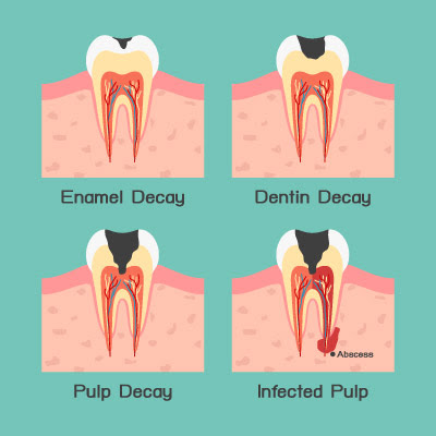Pediatric Dentist, Bangalore: Process of Dental Caries in Children