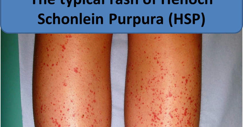 Paediatrics for Primary Care (and anyone else): Henoch Shonlein Purpura ...