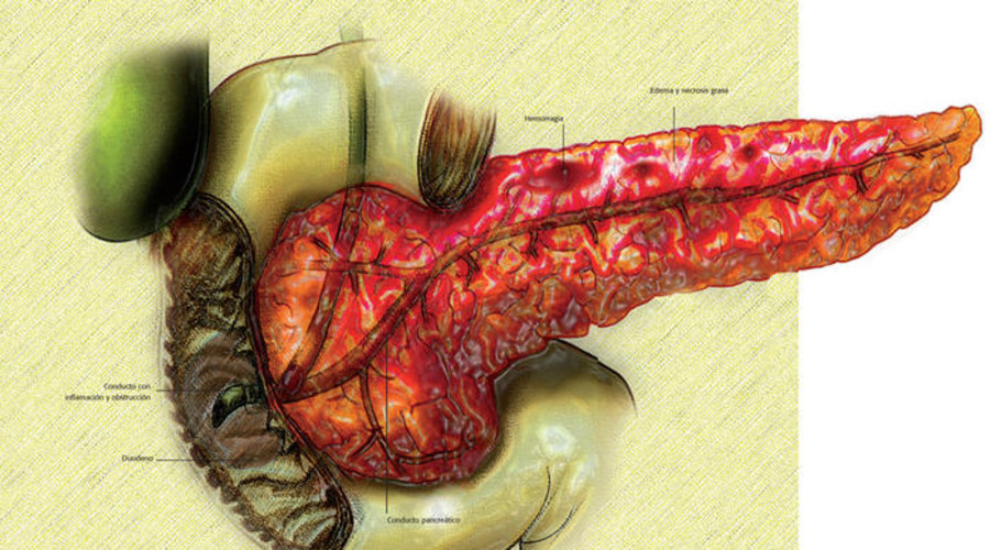 TU SALUD Y LA NUTRICIÓN.: PANCREATITIS
