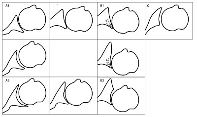 UW Shoulder and Elbow Academy: Glenoid type - Walch classification