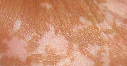Get the best leucoderma treatment in Delhi.