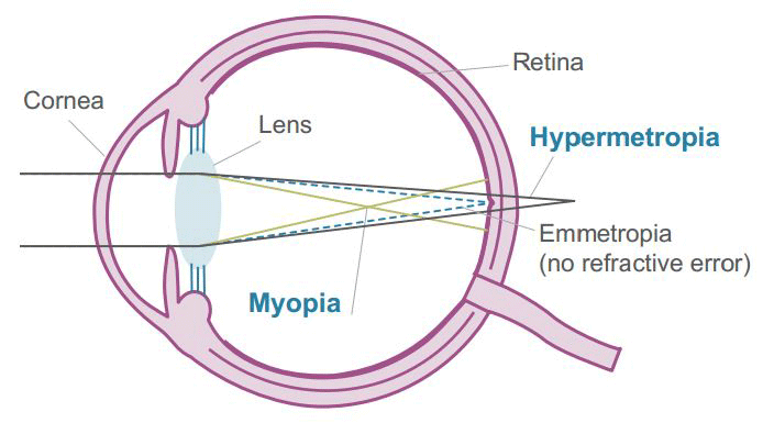 What is Anisometropia And its Management