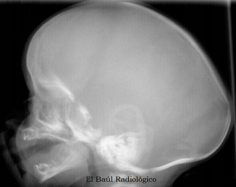 El Baúl Radiológico: CRANEOSINOSTOSIS. CIERRE PREMATURO DE LAS SUTURAS ...