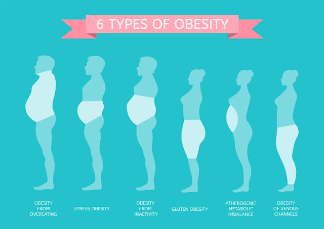 Obesity - Symptoms,Causes,Risk factor,Prevention