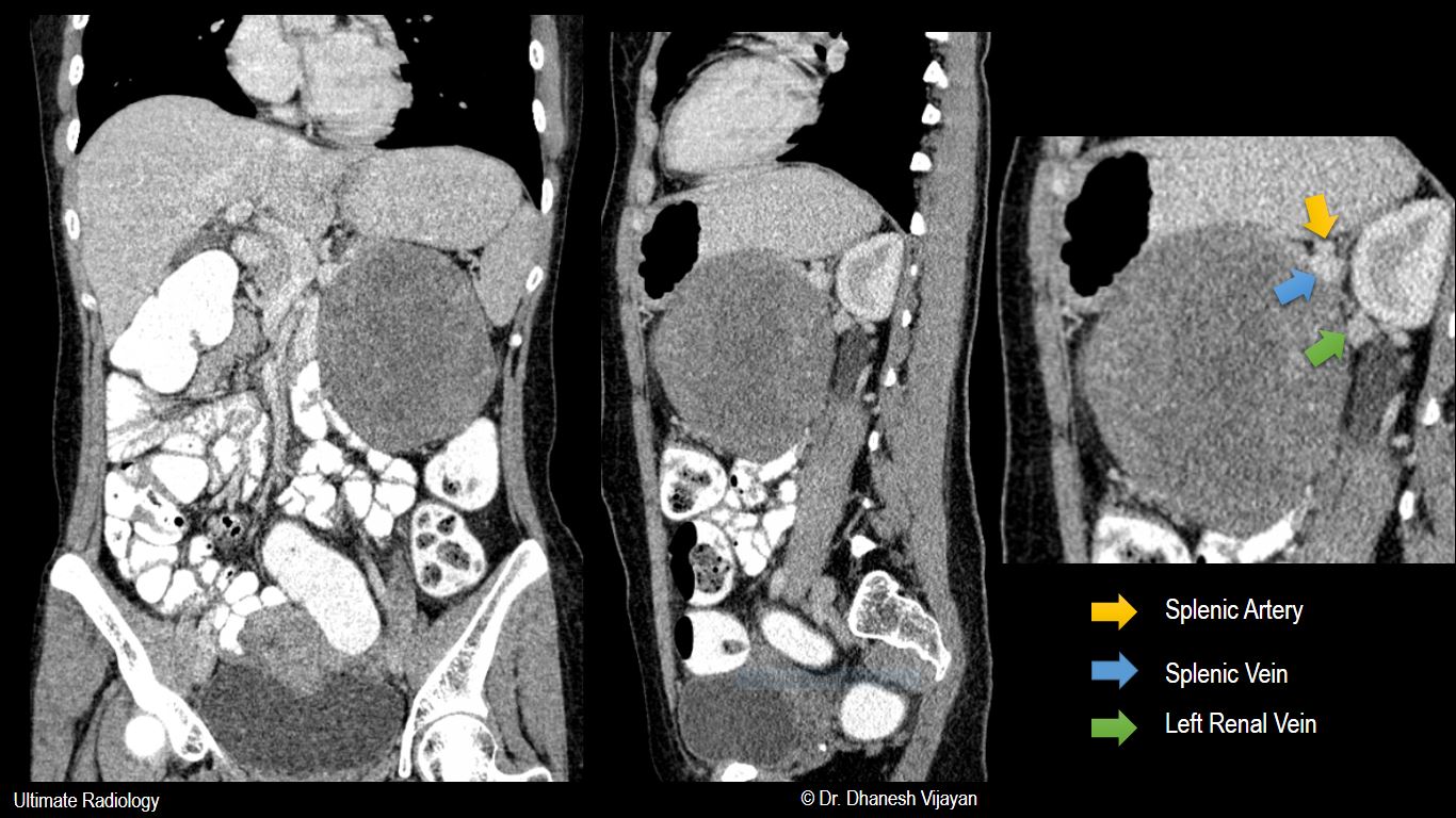 Ultimate Radiology : Solid Pseudopapillary Tumor of Pancreas