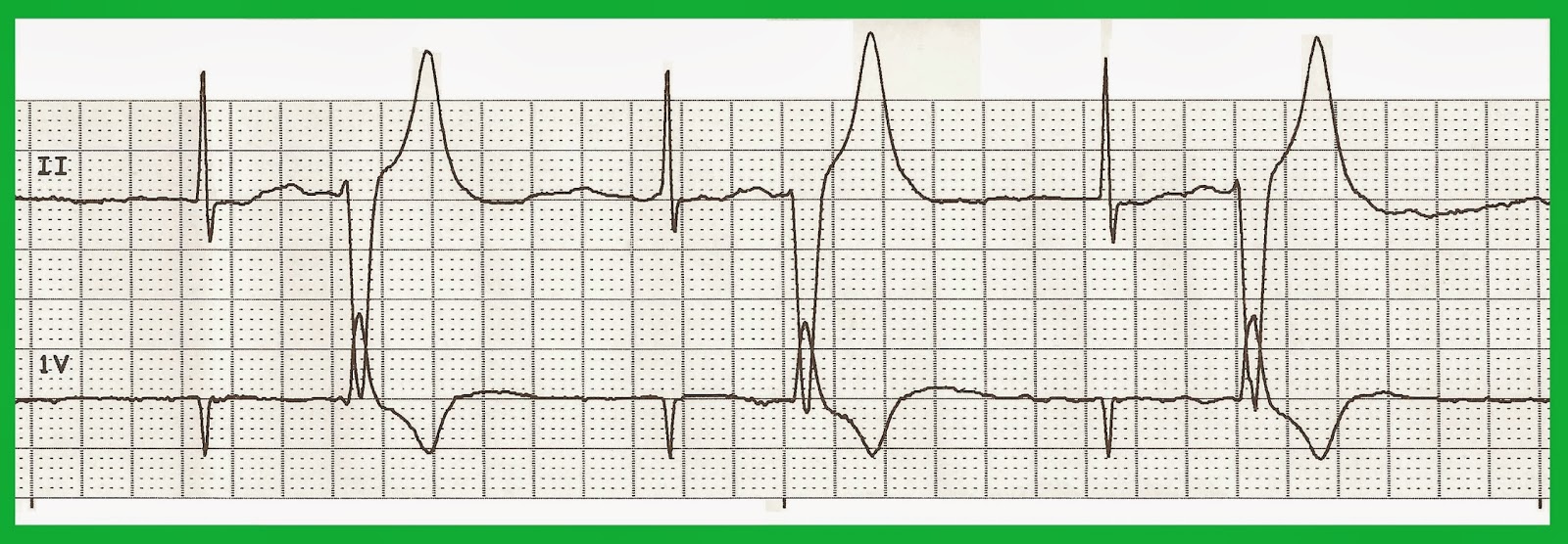 Practice EKG Rhythm Strips 212