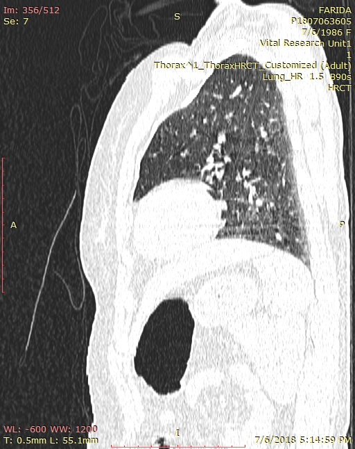 pulmonary inflammatory lesion,Cholelithiasis,Left renal calculus - CT ...