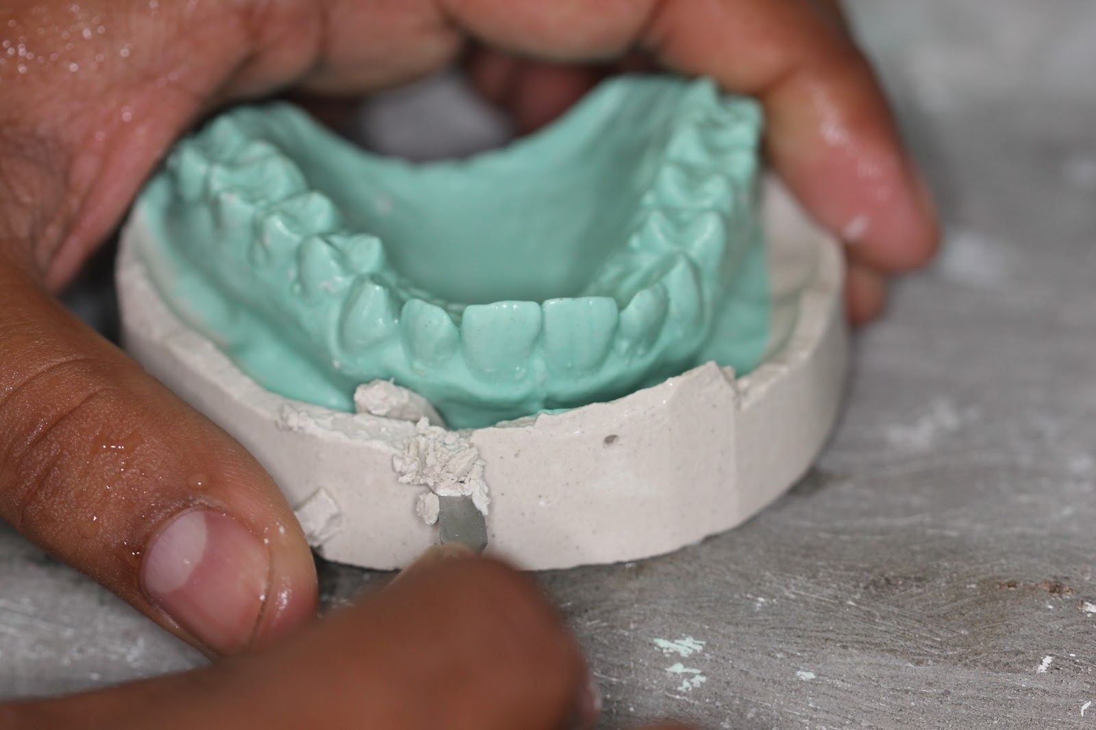 Understanding Prosthodontics - Tagore Dental College & Hospital-By ...