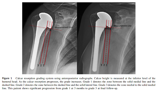 UW Shoulder and Elbow Academy: Total shoulder arthroplasty - medial ...