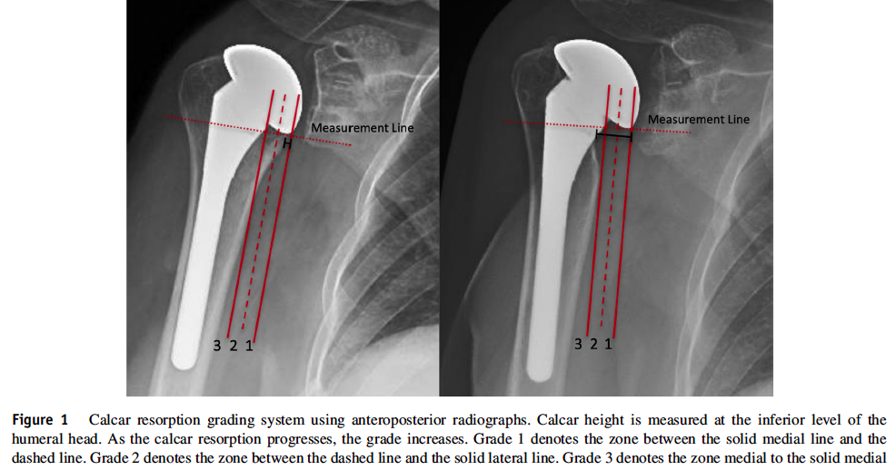 UW Shoulder and Elbow Academy: Total shoulder arthroplasty - medial ...