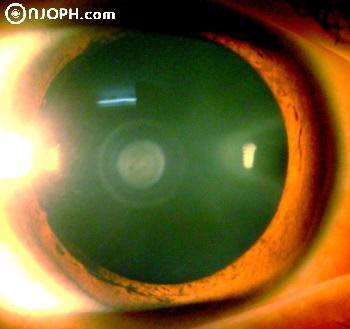 Ophthalmology Notes: Rings in ophthalmology