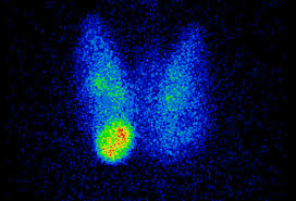 Φαρμακευτικά Μόρια: Ιώδιο 131 - Iodotope