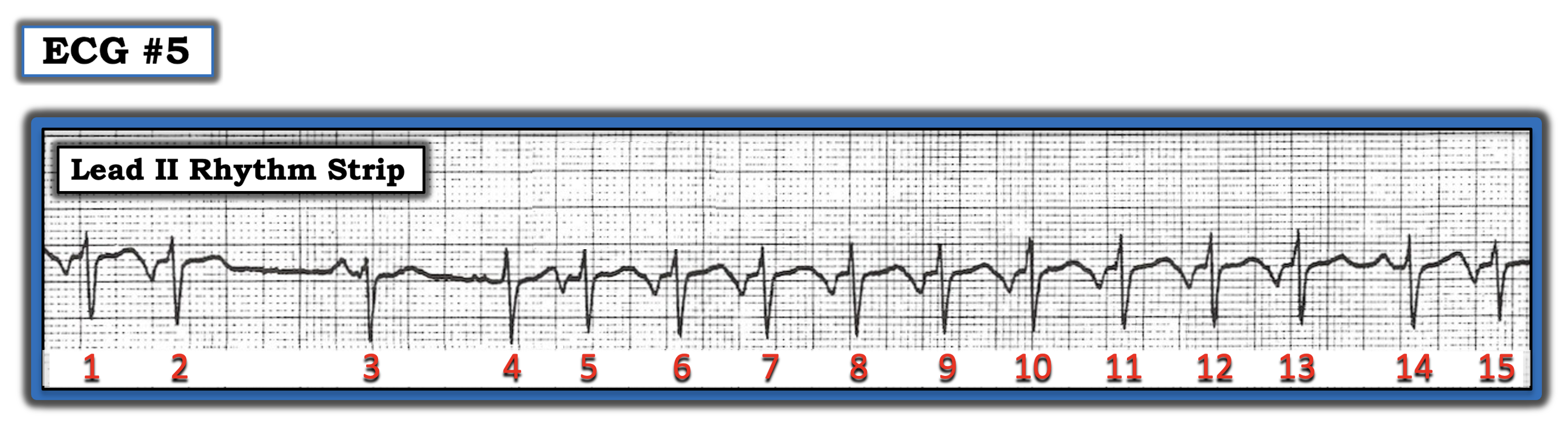 ECG Interpretation: ECG Blog #240 (55) — What Kind of Regular SVT?