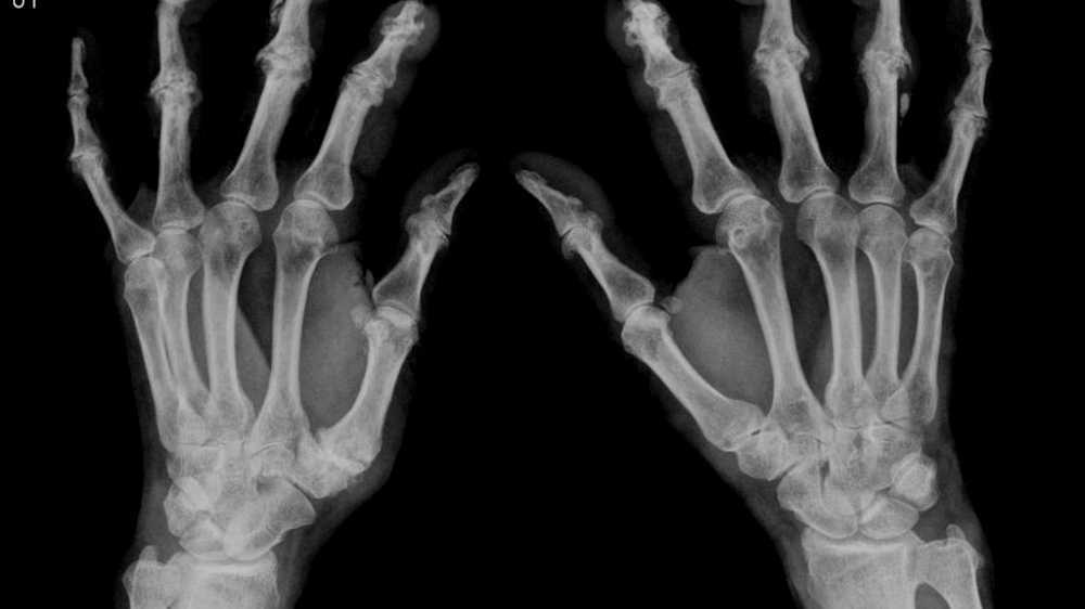 Mixed connective tissue disease