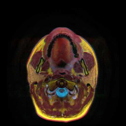 Nevit's blog: Color MRI of the Neck