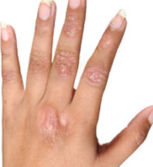 DR CN Rajadurai | PSORIASIS SPECIALITY HOSPITAL | CNR HERBS | CNR HERBS ...