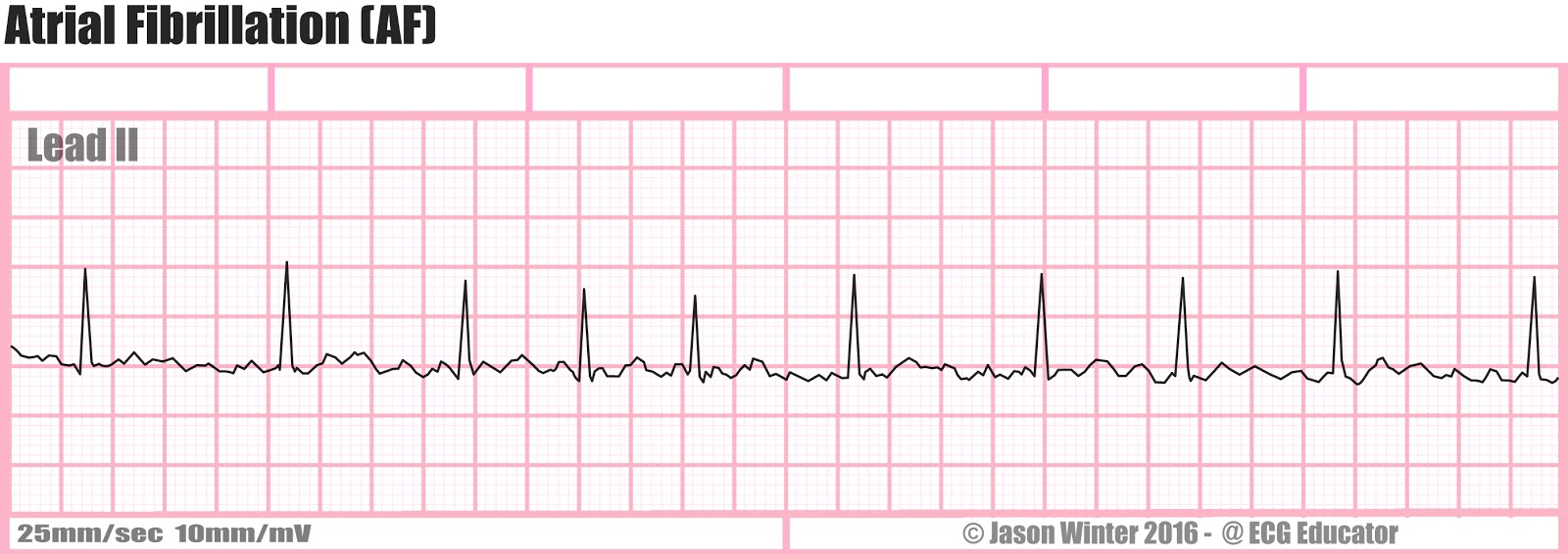 ECG Educator Blog : Six Second ECG Rhythm Strips