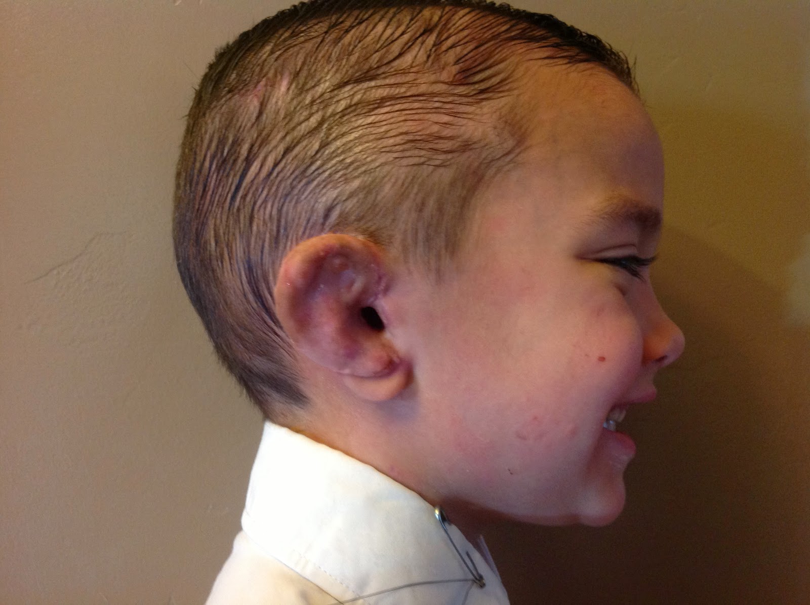Microtia: Microtia Rib Cartliage Ear Surgery done in only ONE surgery!