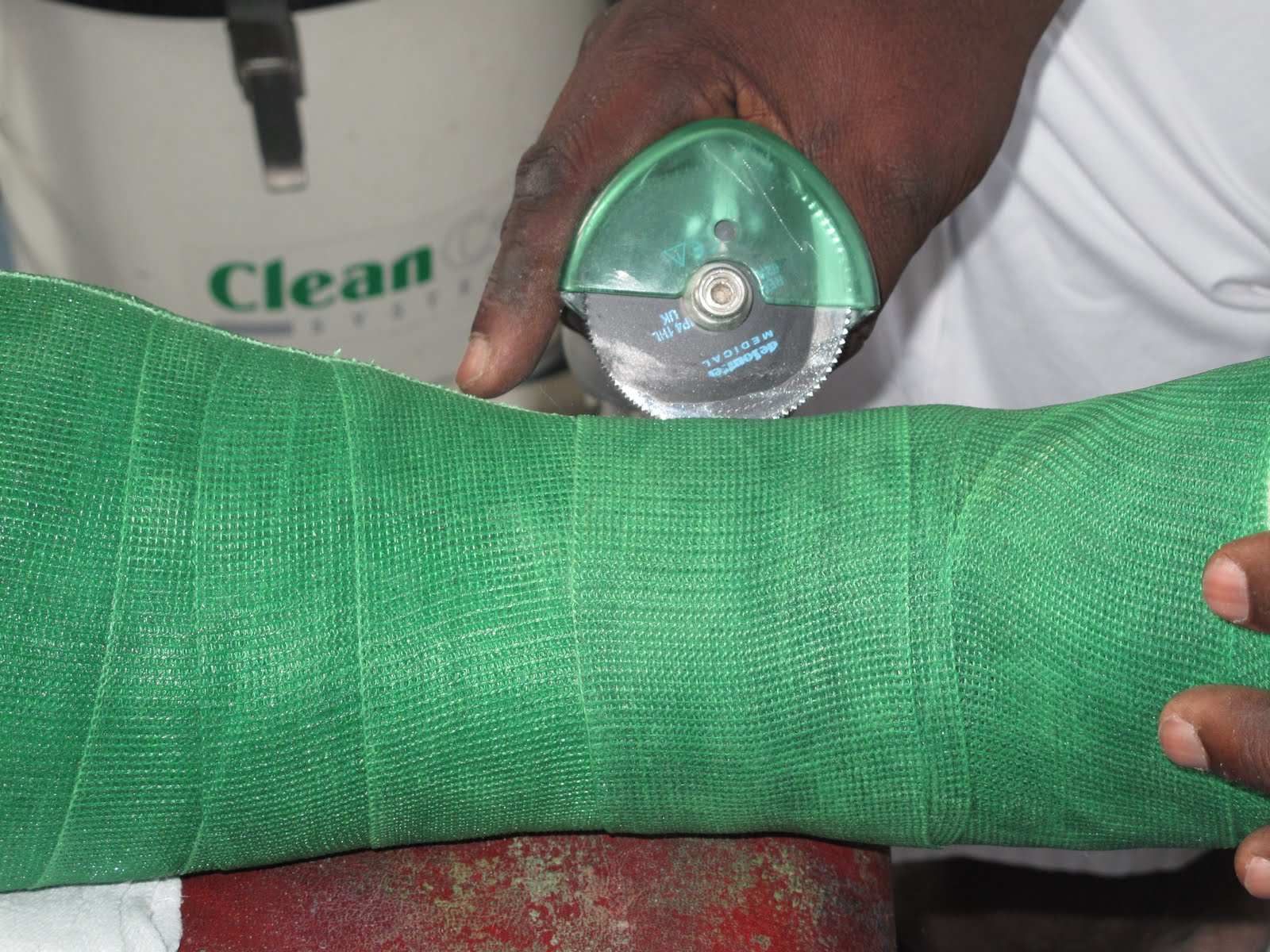 Danielle Roberts: The plaster cast comes off!