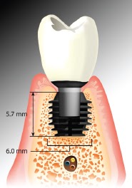 Short Implants: amazing improvement in Implant Dentistry