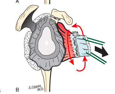 UW Shoulder and Elbow Academy: Shoulder joint replacement - management ...