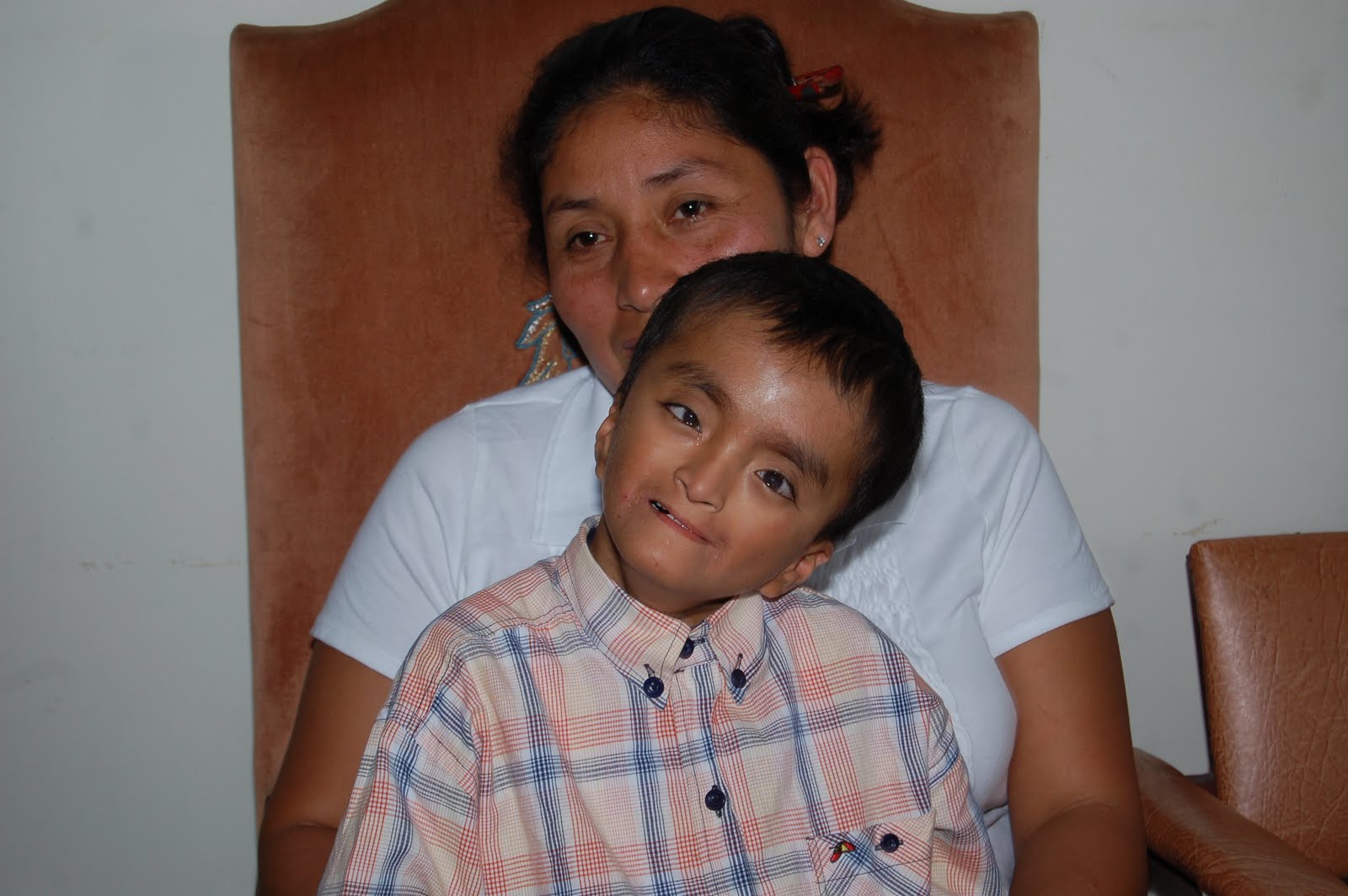 Sindrome Di Hallermann