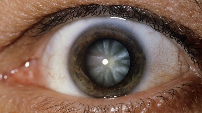 Anomalías de Ojo Interno