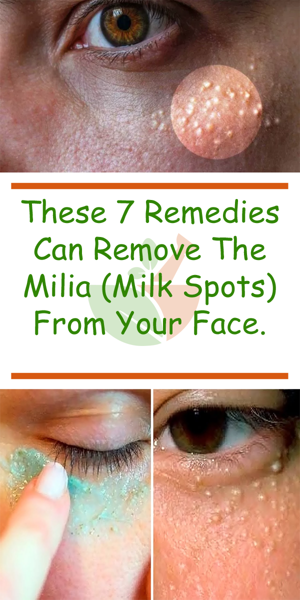 Top 7 Home Remedies To Remove All Milia Permanently Wellness Ways 0000 top-7-home-remedies-to-remove-all-milia-permanently-wellness-ways-0000