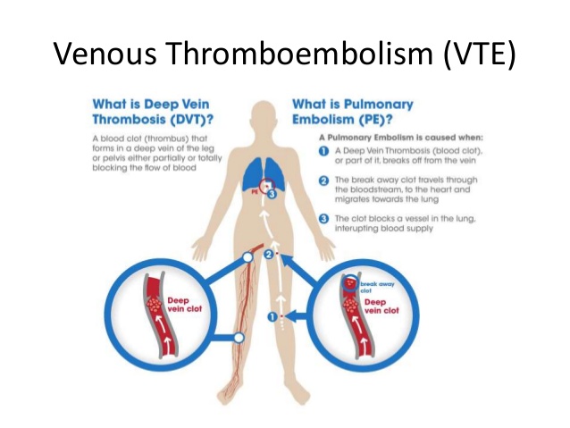 Prepare for Medical Exams : Venous Thromboembolism: Risk factors