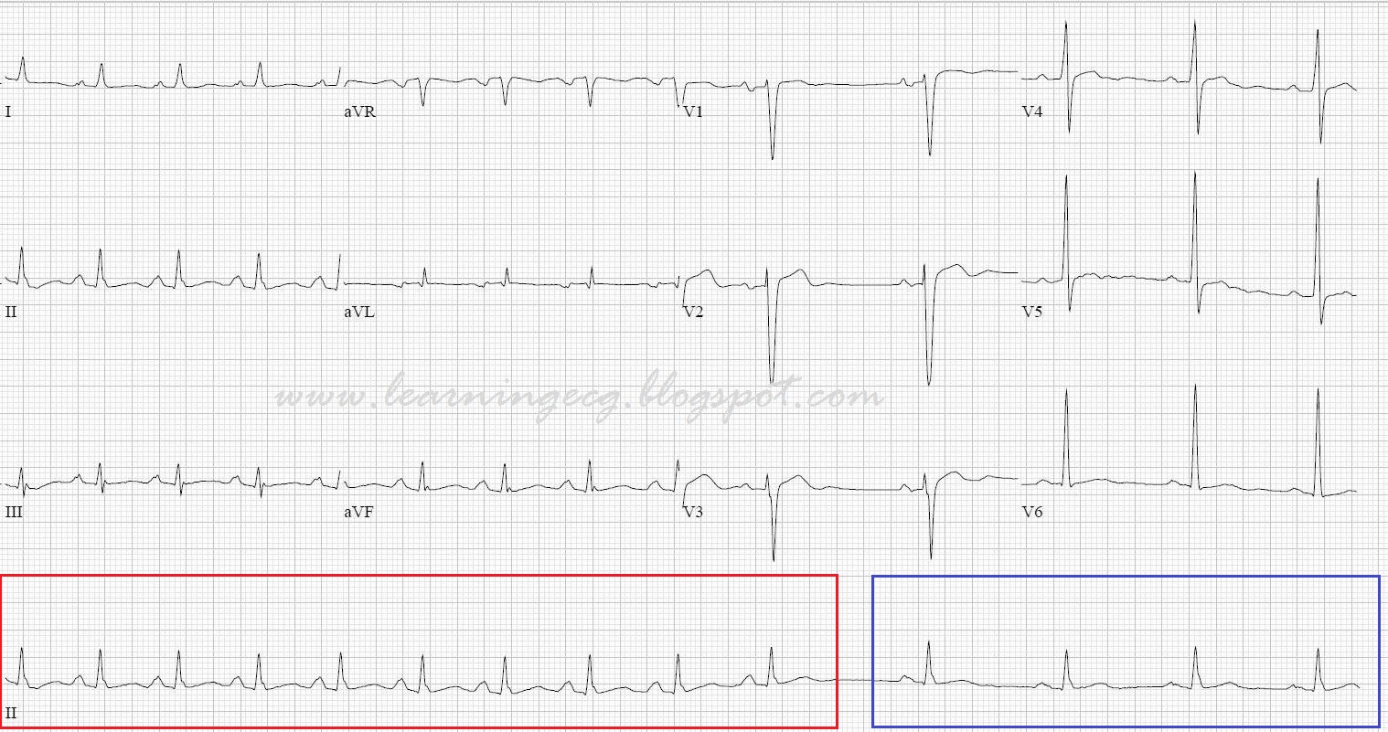 Av Nodal Reentrant Tachycardia Ecg