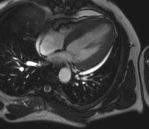 Left Ventricular Hypertrophy- Cardiac MRI - Sumer's Radiology Blog