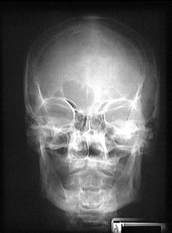 TEKNIK PEMERIKSAAN OS CRANIUM | Kotak Radiologi