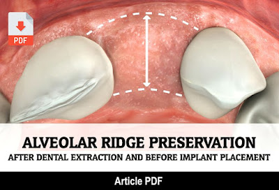 PDF: Alveolar Ridge Preservation after dental extraction and before ...