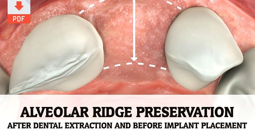 PDF: Alveolar Ridge Preservation after dental extraction and before ...