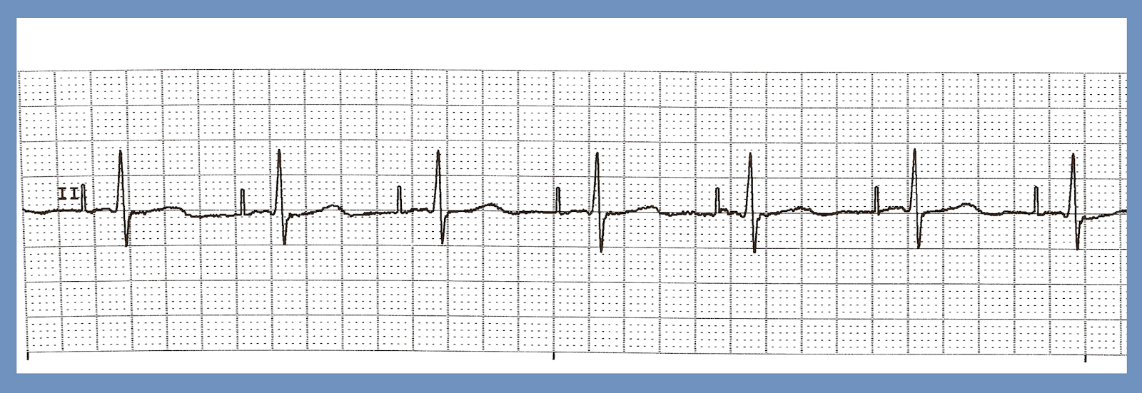 Various Atrial Paced Rhythms