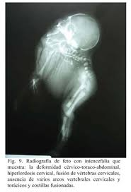 Enfermedades Raras, ¿y eso de qué va?: INIENCEFALIA