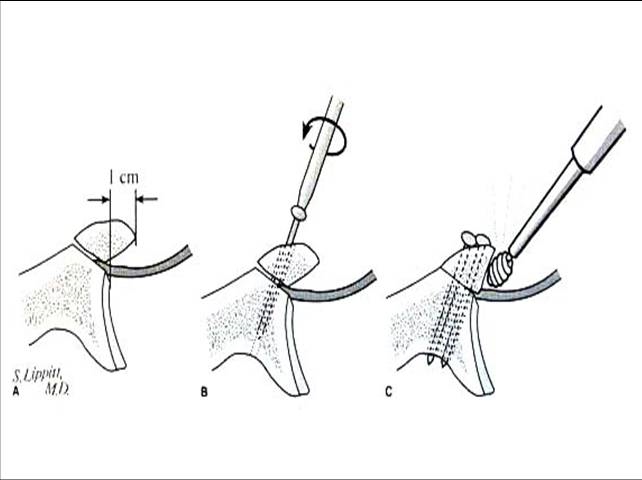 HEALTH FROM TRUSTED SOURCES: Shoulder Surgery