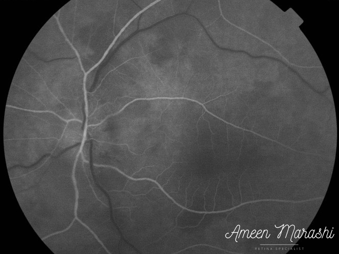 Idiopathic neuroretinitis