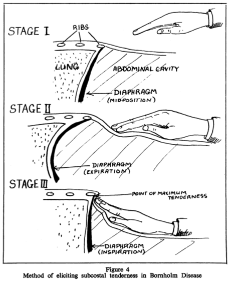 Hospitalist ~なんでも無い科医の勉強ノート~: Bornholm Disease, Epidemic Pleurodynia ...