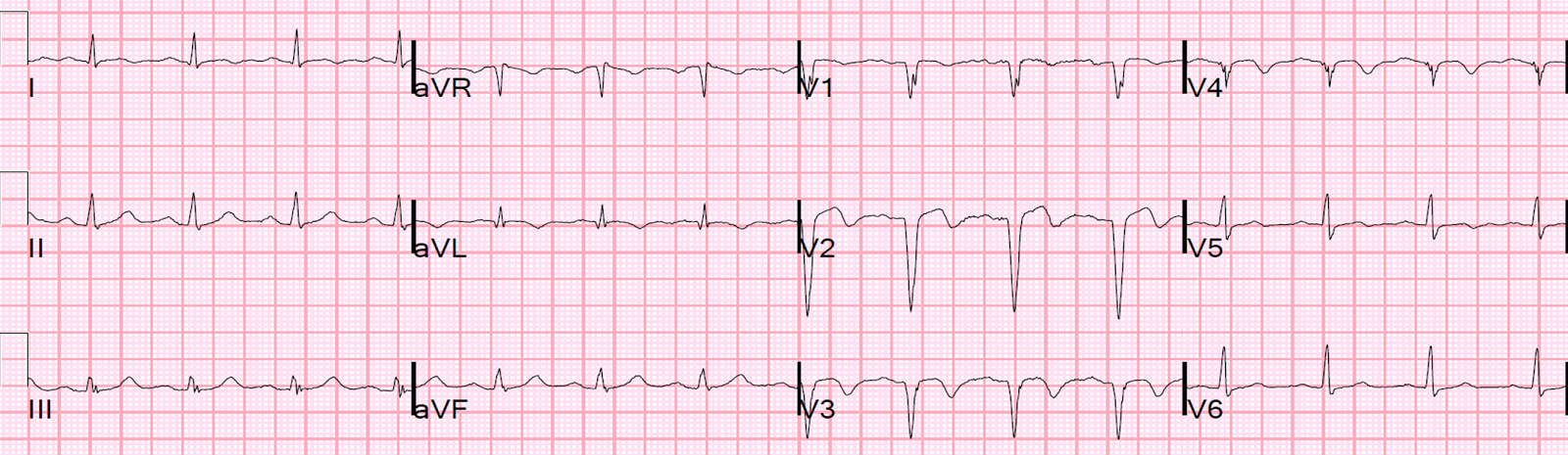 Dr. Smith's ECG Blog: Subtle Anterior STEMI Superimposed on Anterior LV ...