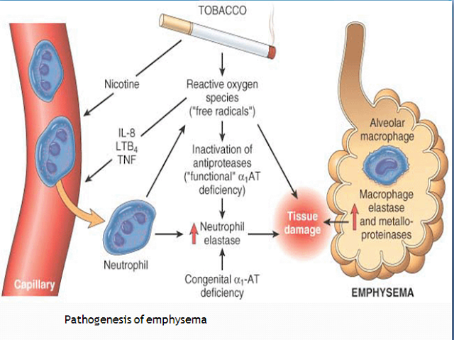 Emphysema