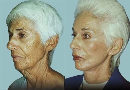 Fill Out And Expand Sunken Cheeks With Facial Aerobics Exercises ...